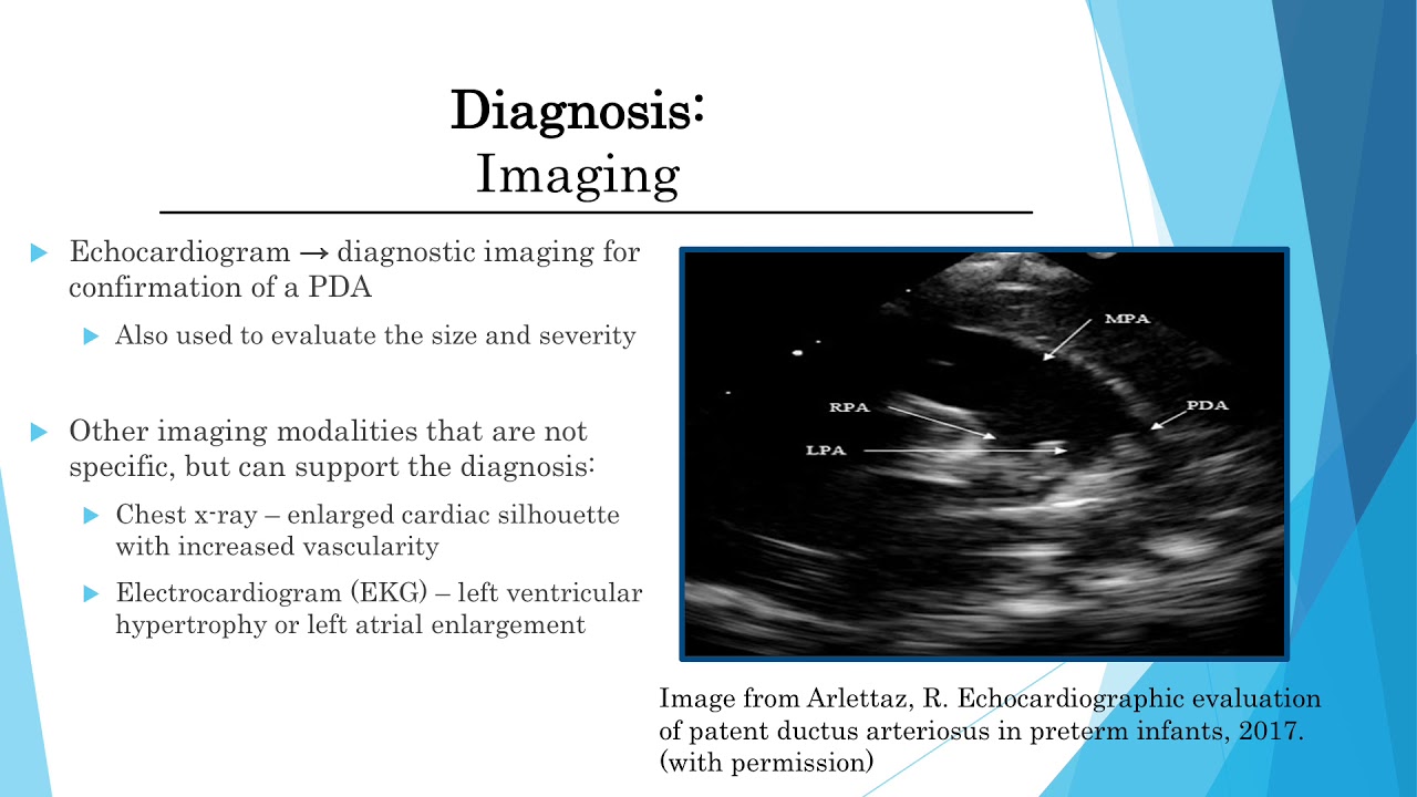Gould Final PPT for Mrs  Clawson - Patent Ductus Arteriosus