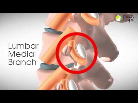 Diagnostic Lumbar Medial Branch Blocks