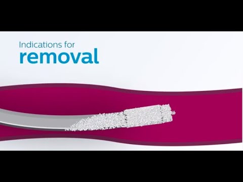CIED Infection Treatment Options Animation
