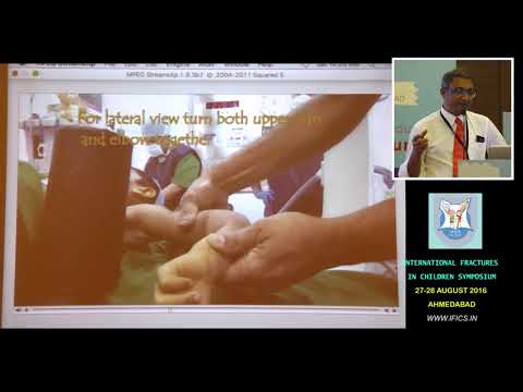 TARAL NAGDA SUPRACONDYLAR FRACTURE CLOSED REDUCTION AND INTERNAL FIXATION VIDEO TECHNIQUE IFICS 2016