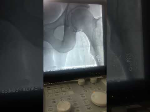 Periferik arter hastalığı olan hastamızı sağlığına kavuşturduk.