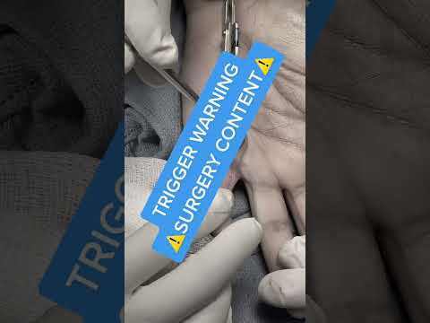 Finger Laceration: Tendon Demonstration
