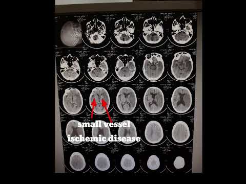 Abnormal brain #ct scan findings #radiology #shortvideo