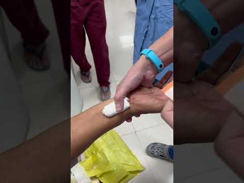 how to remove Radial sheath after angio or plasty #angiography #angioplasty #cardiology #cathlab