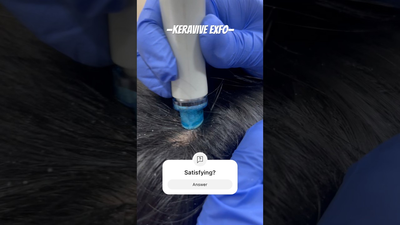 Keravive HydraFacial Treatment for Hair loss, Hair Thinning or a Dry, Itchy scalp | DMC Trichology