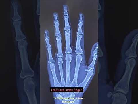Finger fracture treatment with K wires