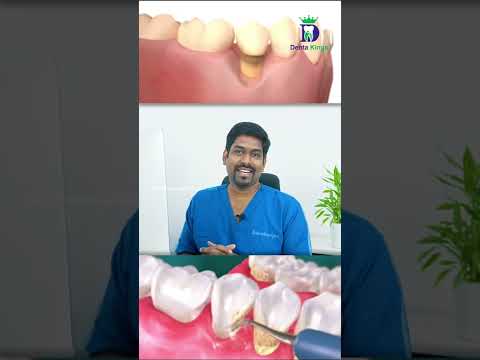 Dental Cleaning தேவையா? | why Dental Scaling Necessary? | Denta Kings
