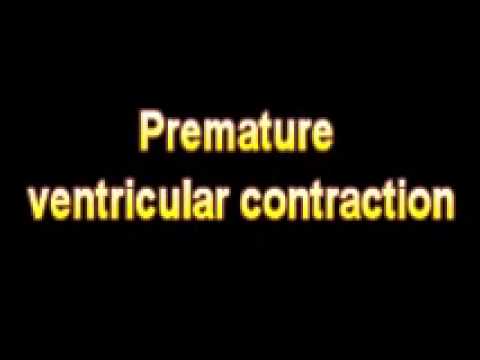 What Is The Definition Of Premature ventricular contraction Medical School Terminology Dictionary