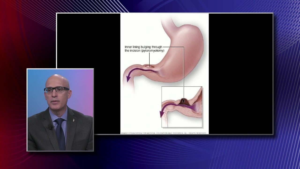 Laparoscopic Pyloromyotomy