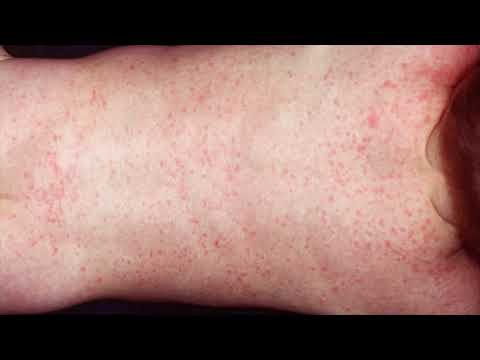 Difference Between Measles and Roseola