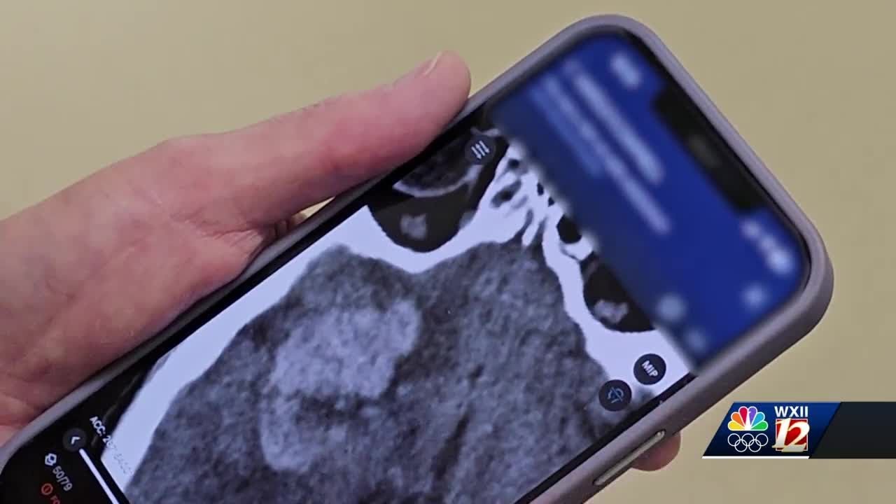 Doctors using AI to help stroke patients