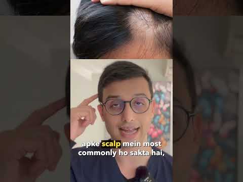 What is Alopecia Areata || Alopecia Areata kya hota hai || Dr Ankur Sarin ||