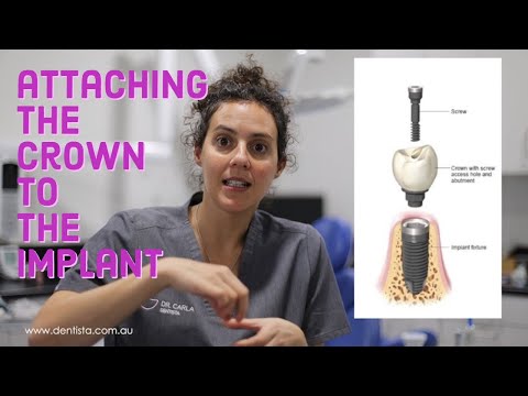 A Screw in a Screw?! ๐คฏ How does a crown get attached to a dental implant?