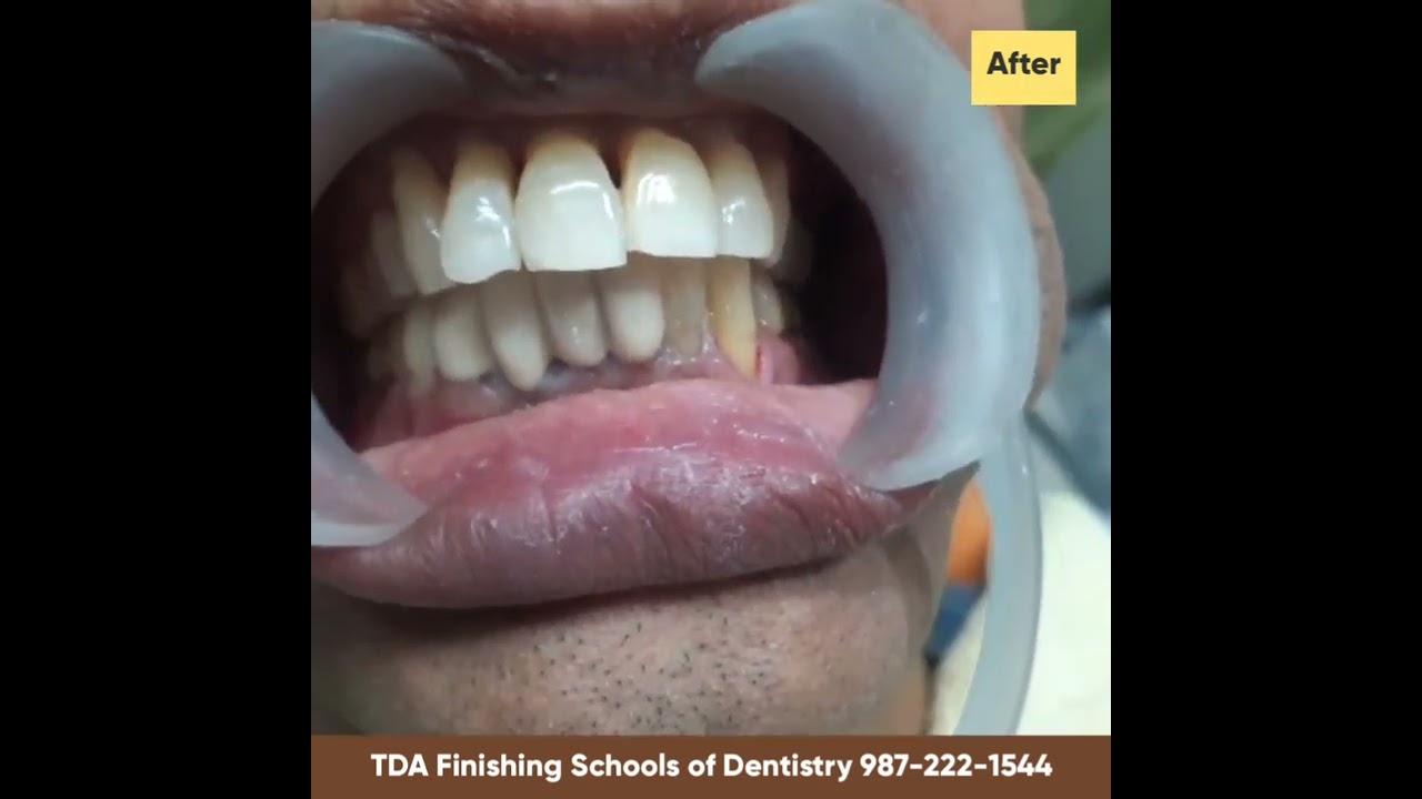 Successful Fixed partial denture (FPD) delivered by TDA student