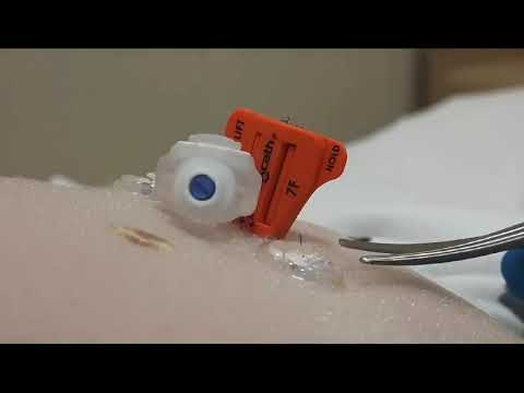 Gastrostomy tube suture removal (IR inserted)