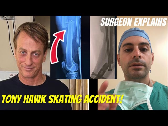 What happened to Tony Hawk? Skateboarding legend suffers broken femur ...