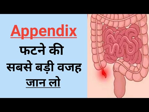 Appendix क्या होता है? | what is appendix | Appendix symptoms & Diagnosis | Appendix hone ke karan
