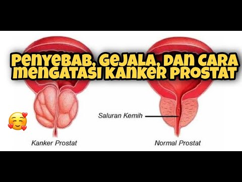 APA ITU KANKER PROSTAT? PENYEBAB, GEJALA, DAN CARA MENGATASI KANKER PROSTAT - Record by Olga