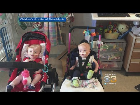 Doctor Reveals New Details About Historic Surgery Separating Conjoined Twins At CHOP
