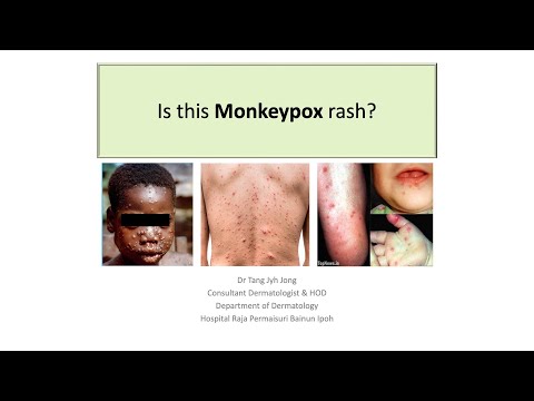 Is this Monkeypox rash?