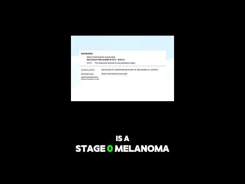Melanoma In situ lentigo maligna