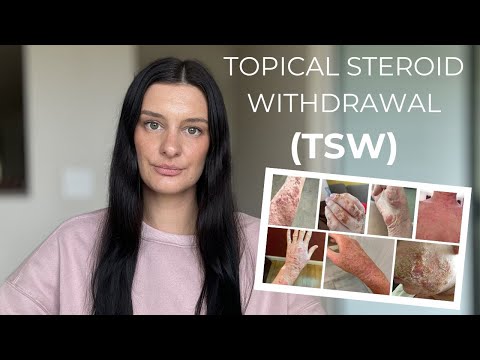 Topical Steroid Withdrawal (TSW) | WATCH THIS BEFORE USING TOPICAL STEROIDS | Dr. Sienna Miller, ND
