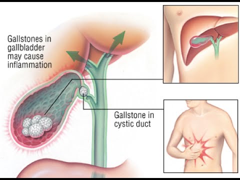 Cholecystitis