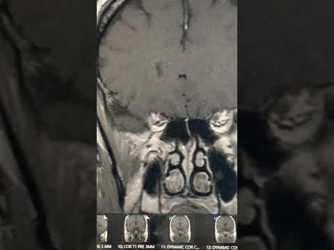 MRI review of a patient with hypoprolactinemia.