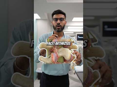 What is the treatment for facet arthrosis? #backpaintreatment #backpain