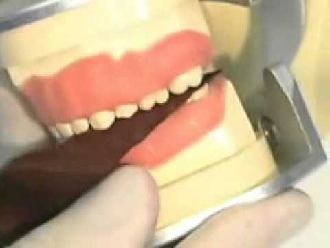 Stainless Steel Crown Restoration.mov