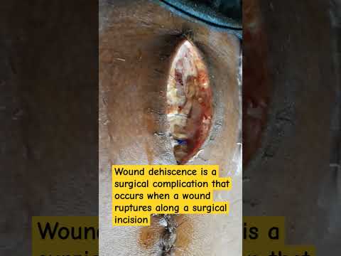 Wound Dehiscence in midline incision post emergency #Laparotomy #Surgery