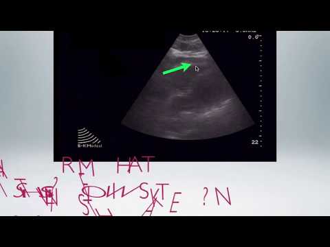Cardiac Effusions and Tamponade/ ultrasound/echo