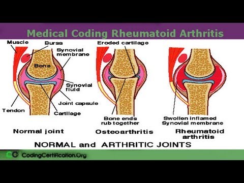 How to Code Rheumatoid Arthritis โ Medical Coding Tips