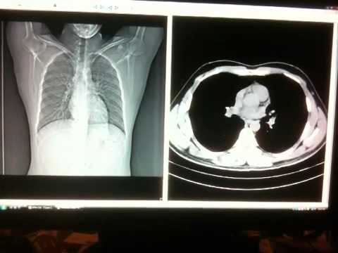 CT Scan - Cat Scan healthy lungs