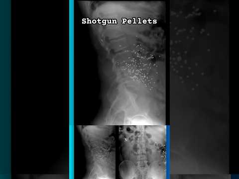 ⚠️SHOTGUN INJURY X-RAY⚠️ #shorts #radiology #trauma