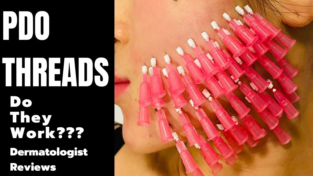 Thread Lifts | PDO Threads- Are they worth it?