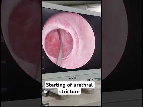 Urethral Stricture how it looks early phase