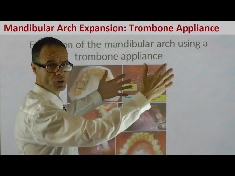 Expansion of the Mandibular Arch (Lower Jaw) Using a Trombone Appliance by Dr Mike Mew