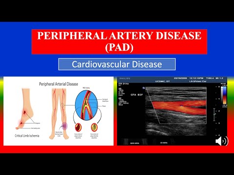 PERIPHERAL ARTERY DISEASE (PAD) - Definition, types, cusses, pathophysiology, symptom, medicine