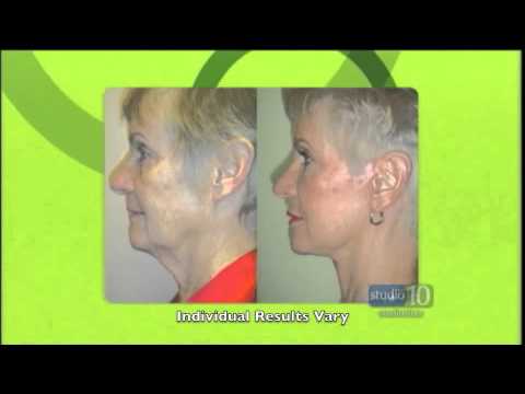 Castellano Facelift Tampa FL - Call 877.346.2435 Cosmetic Surgery in Tampa