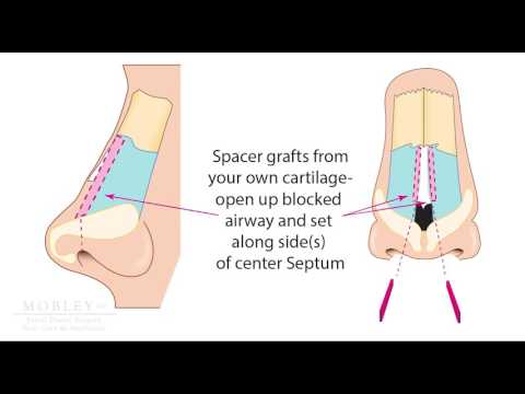 Understanding Nasal Valve Surgery
