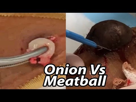Meatball or Onion Cysts? What is Better?