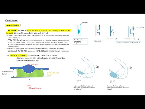 NSTEMI angiographic and PCI tips
