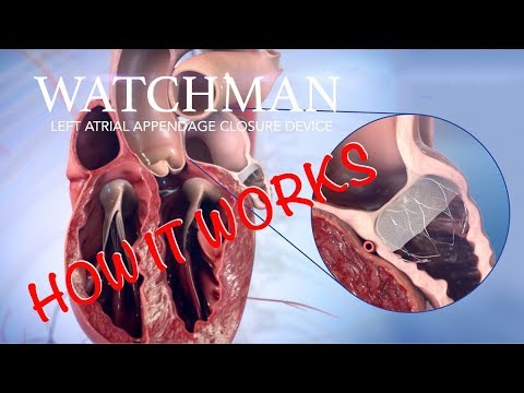 HOW WATCHMAN IMPLANTATION DEVICE WORKS