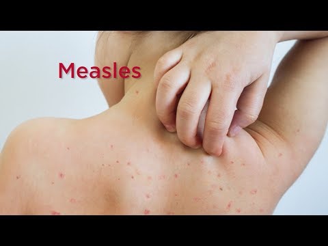 Measles | Line One: Your Health Connection