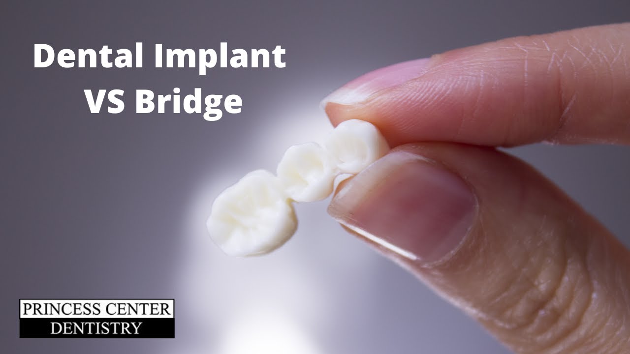 Dental Implant vs Bridge