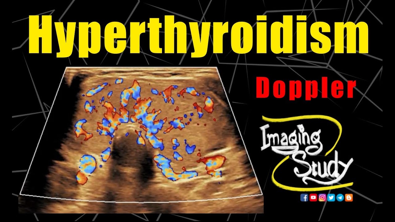Understanding Hyperthyroidism: A Case Study with Ultrasound and Doppler ...