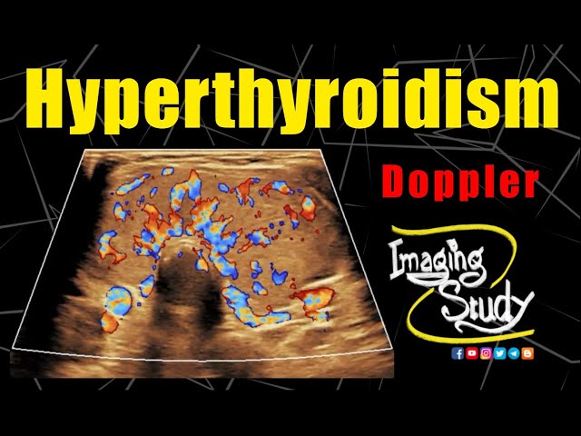 Understanding Hyperthyroidism: A Case Study with Ultrasound and Doppler ...