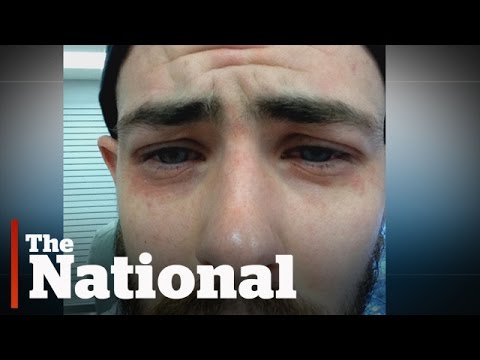 Marijuana allergy can be triggered by toking