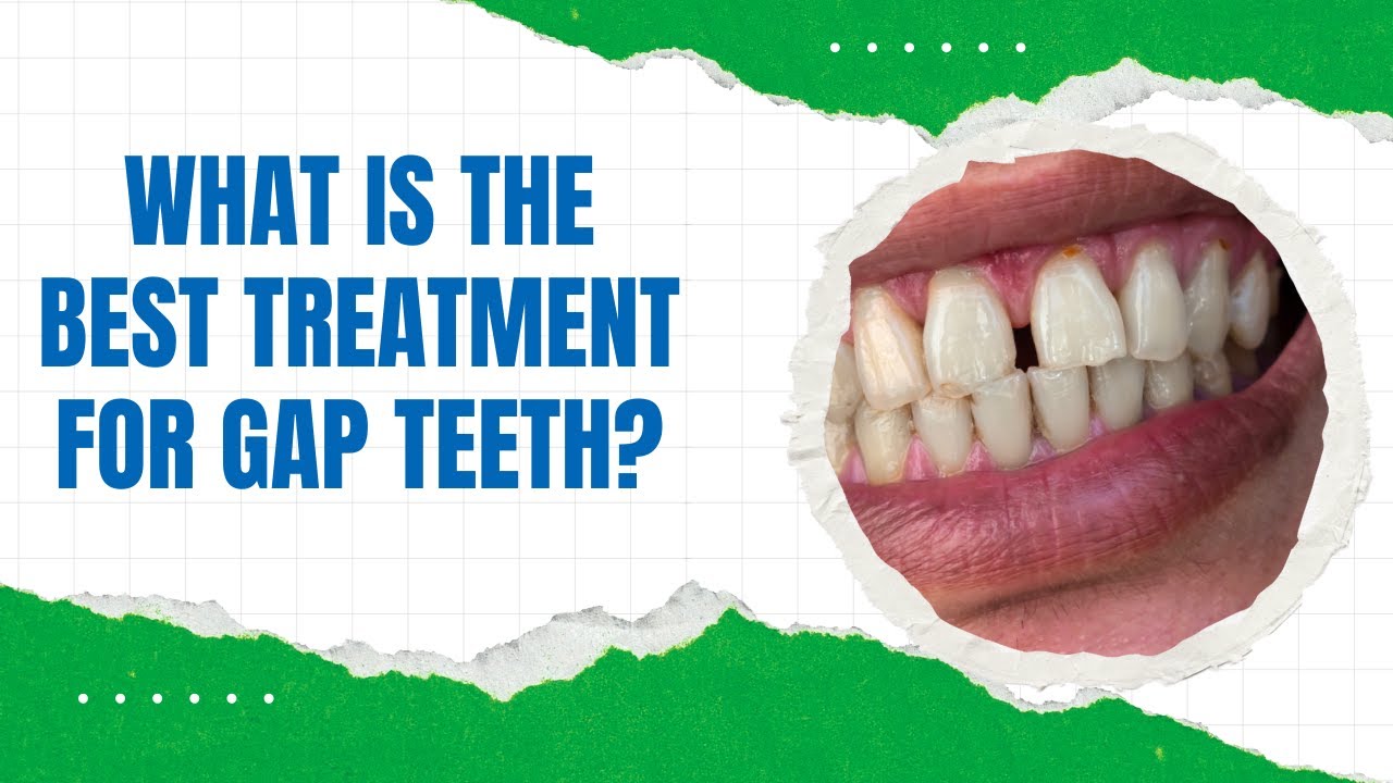 What Is the Best Treatment for Gap Teeth? | Dental House MI